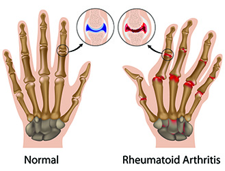 Arthritis – The Disability Resource